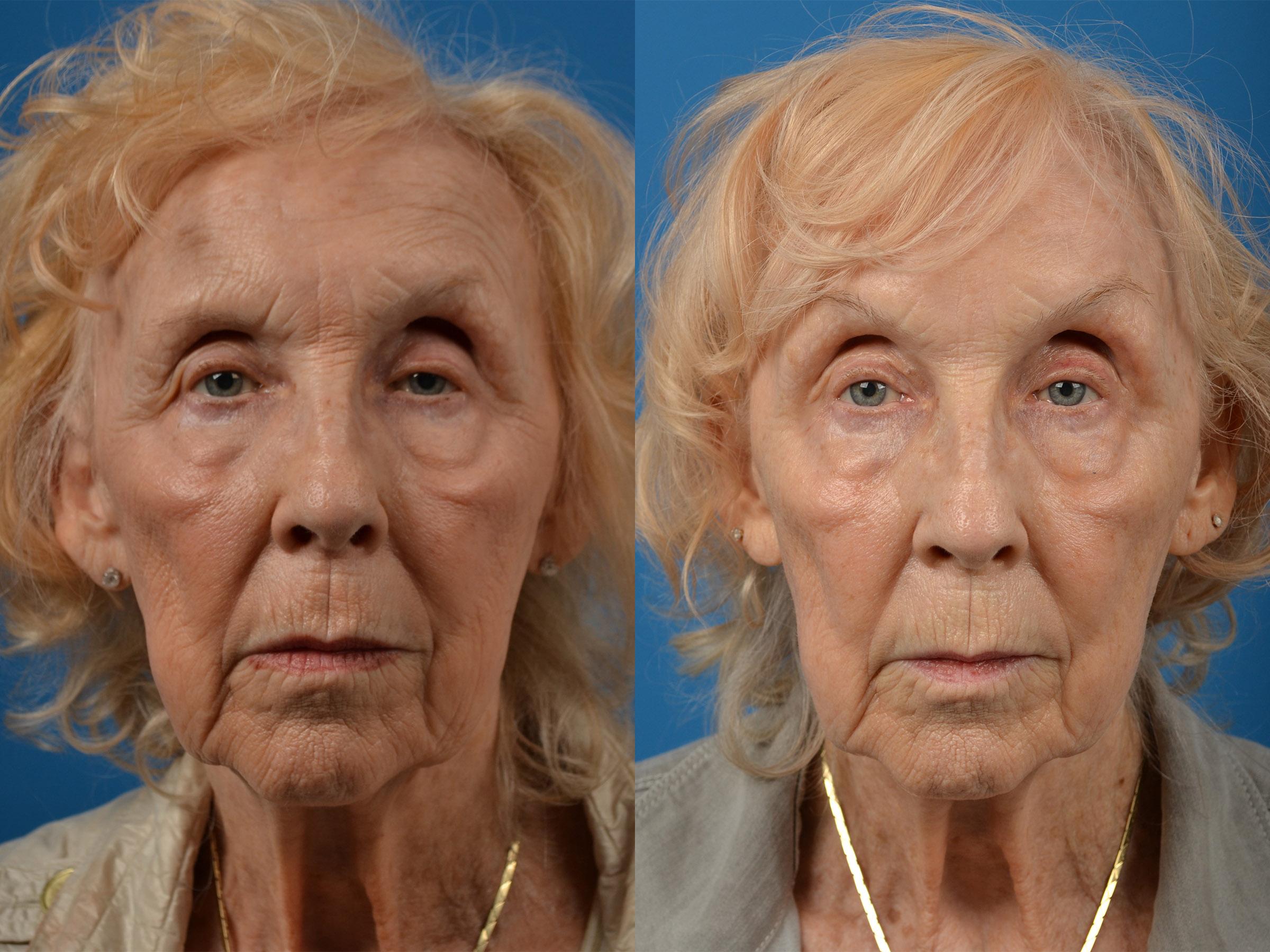 Brow Lift Photos Melbourne Fl Patient 53342